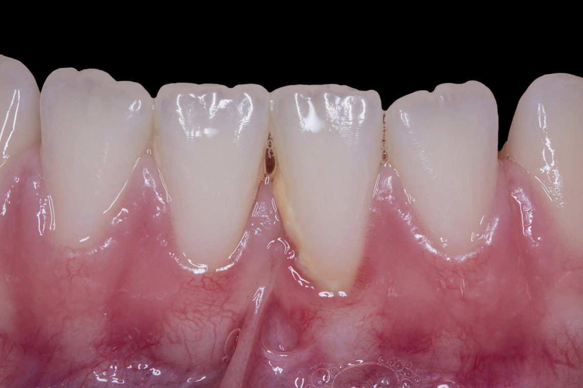 Gum Grafting - Orange Periodontics and Dental Implantology